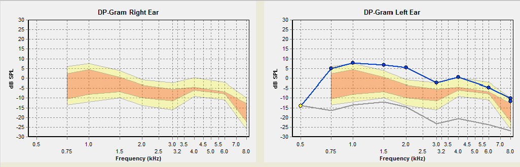 گسیل‌ های صوتی اعوجاجی گوش (DPOAE) - کلینیک الوند